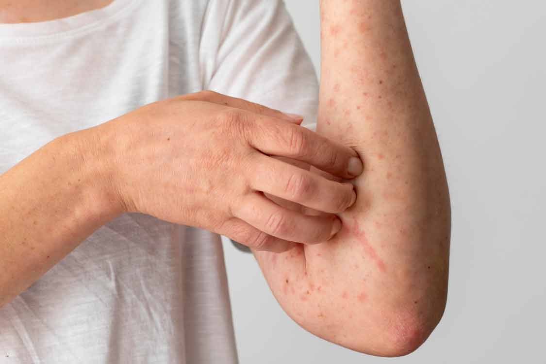 Alerjik Rinit Nedir? Belirtileri ve Tedavisi - Fitoterapi ve Sağlık